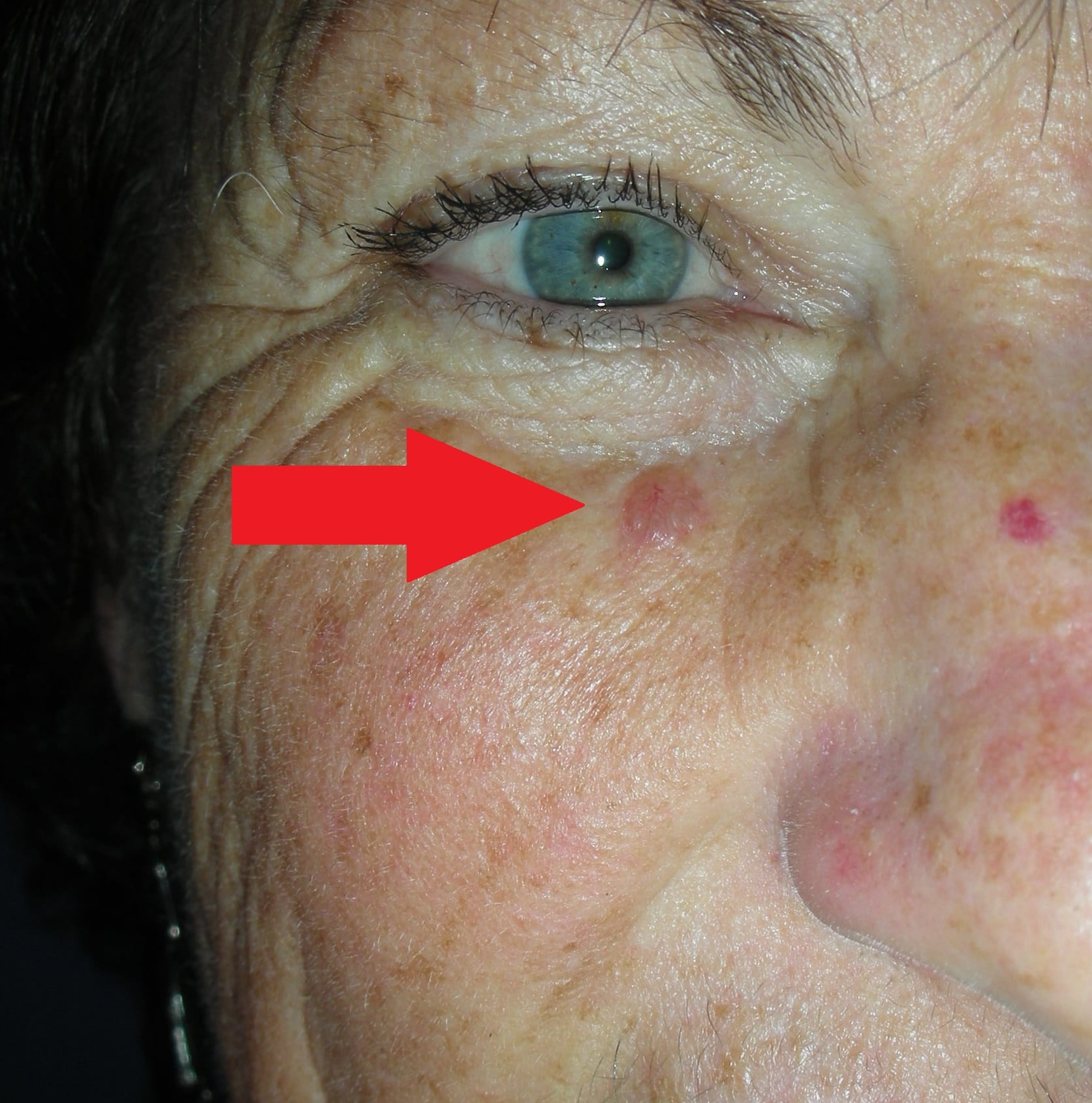 Skin Cancer On Cheek